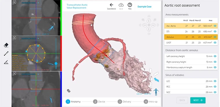 Materialise amplía las soluciones cardiovasculares con la compra de FEops